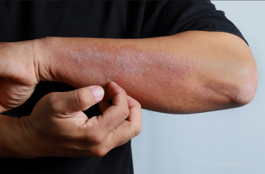 Natural and easy ways to reduce skin irritation - Kiara Naturals