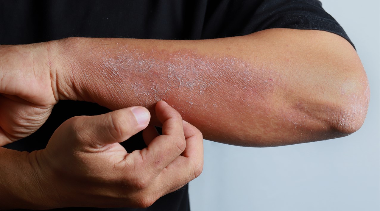 Natural and easy ways to reduce your skin irritation (psoriasis, eczema ...